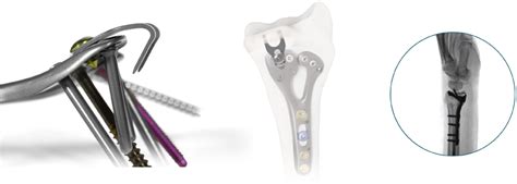Geminus Volar Distal Radius Plate Skeletal Dynamics Skeletal Dynamics