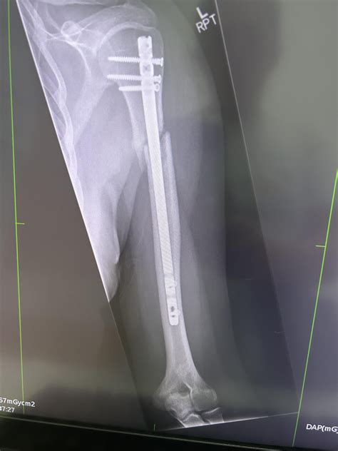 3 Month Post Op R Brokenbones