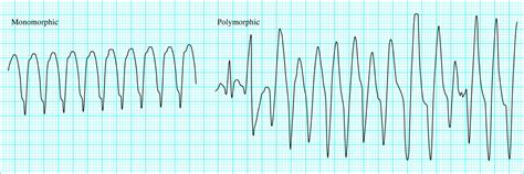 Broad Complex Tachycardia—part I The Bmj