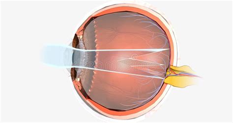 Astigmatism Is An Eye Condition Characterized By An Oval Shaped Cornea