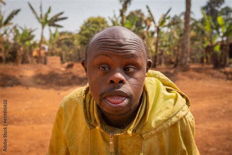 Portrait Of An Adult Bald African Man With Down Syndrome On A Forest Background Stock Foto