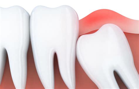 Understanding Wisdom Teeth Removal What To Expect