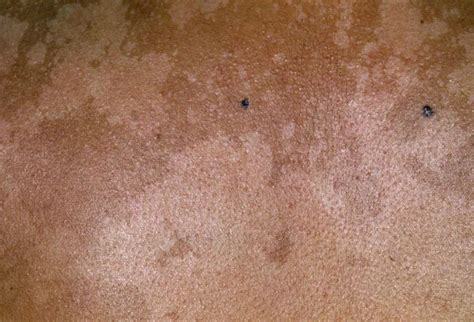 Pityriasis Versicolor Pityriasis Versicolor