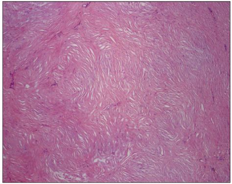 Storiform Pattern In Dermatopathology Indian Journal Of Dermatology