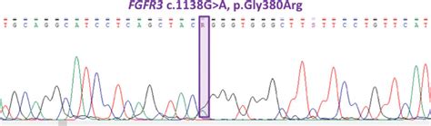 Sequencing Result Presented A Typical Achondroplasia Ach Causing