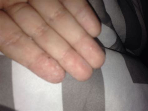 The Best Ways To Get Super Glue Off Skin WikiHow