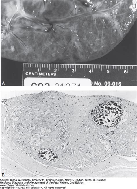 Twin Reversed Arterial Perfusion Sequence Obgyn Key