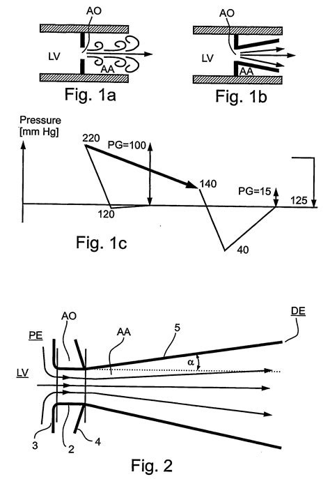 Prosthetic Valve Patented Technology Retrieval Search Results Eureka