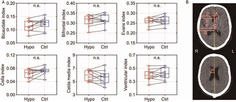 Hypoperfusion And Brain Atrophy Brain Atrophy Indices Of The Bilateral Download Scientific