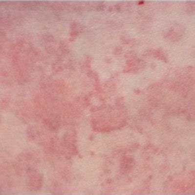 Urticarial Rash At Presentation Download Scientific Diagram