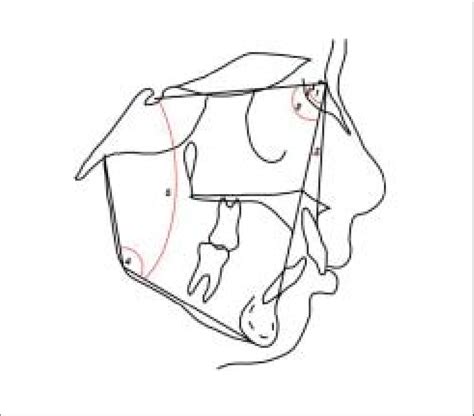 cephalometric landmarks reference lines and angular measurements used