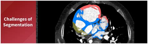 Challenges Of Segmentation For 3d Printing 3d And Quantitative Imaging Laboratory