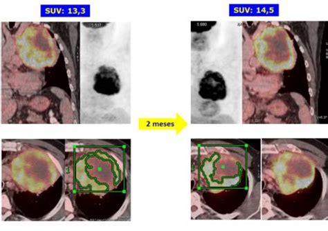 Figure 1 from IMAGEN PET-TC EN EL MANEJO DEL NODULO PULMONAR Y EN EL ...