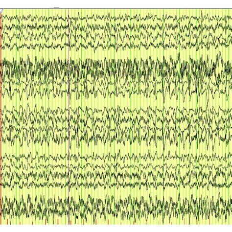 Eeg Showing Epileptiform Discharges Synchronous And Asynchronous With Download Scientific