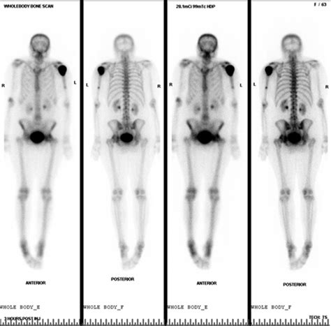 Nuclear Medicine Tc 99 Bone Scan Demonstrating Intense Increased