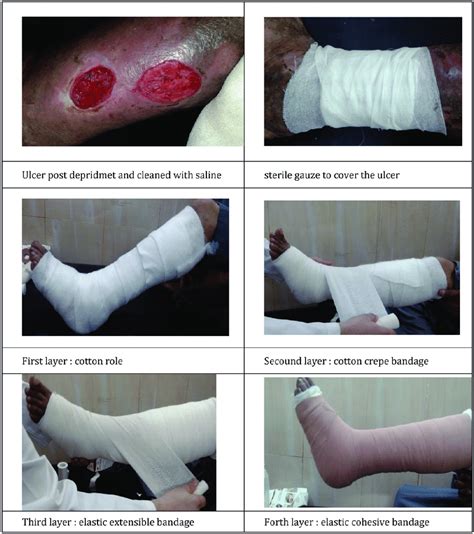 Four Layer Compression Bandaging Steps Download Scientific Diagram