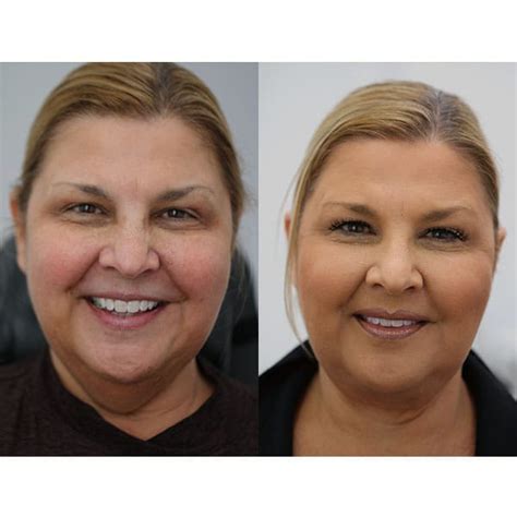 Pdo Threads Destin Medical Spa