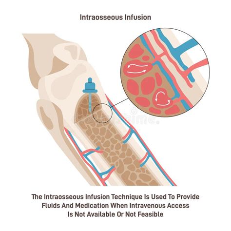 Intraosseous Injection Stock Illustrations 2 Intraosseous Injection Stock Illustrations
