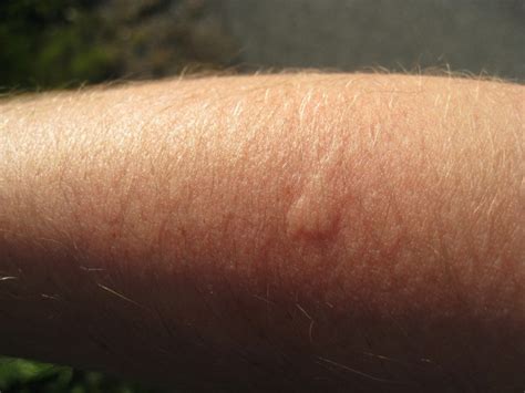 In Deze 9 Gevallen Heb Je Behandeling Nodig Voor Een Insectenbeet