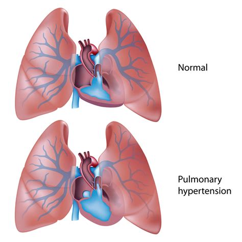 Selexipag Reduces Risk Of Morbiditymortality Episodes In Pulmonary