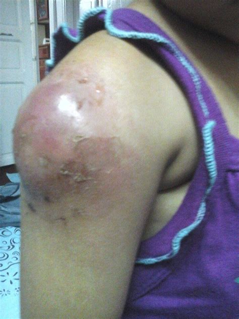 Giant Abscess