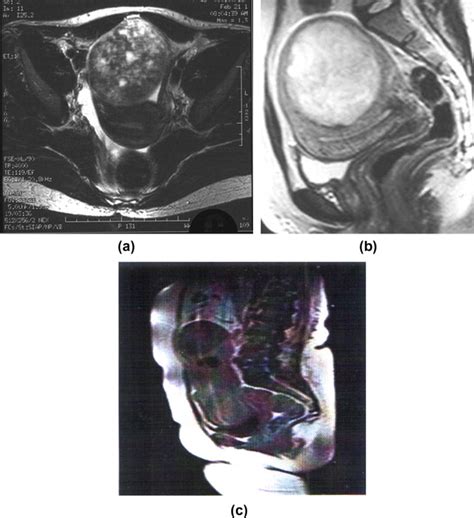 A Axial T2 Weight Image Showing Multiple Fibroids B Sagittal Download Scientific Diagram