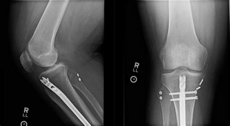 Proximal Tibiofibular Joint