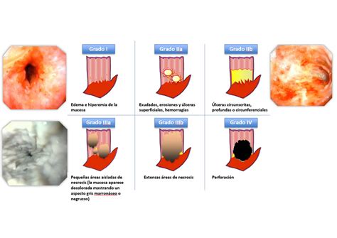 Endiba Herramientas Para Endoscopistas