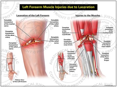 Left Forearm Muscles