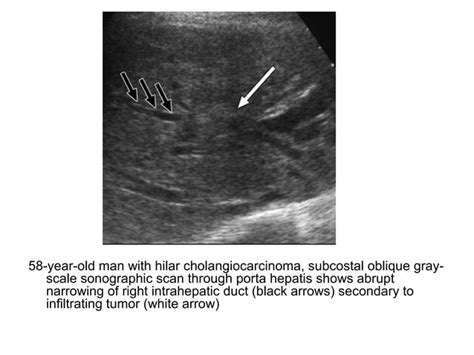 Diagnostic Imaging Of Cholangiocarcinoma Ppt Digestive Disorders