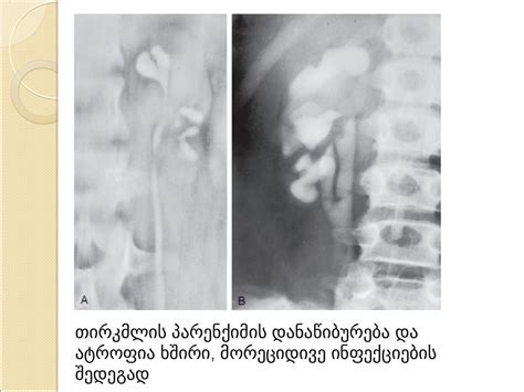 საშარდე გზების ინფექციები ლექცია 5 Online Presentation