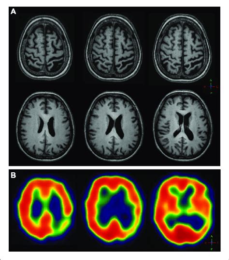 A T1 Weighted Axial Mr Image Of The Brain Showing Diffuse Cortical Download Scientific
