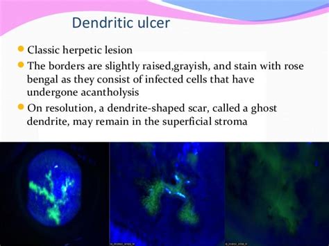 Herpes Simplex Keratitis And Herpes Zoster Opthalmicus