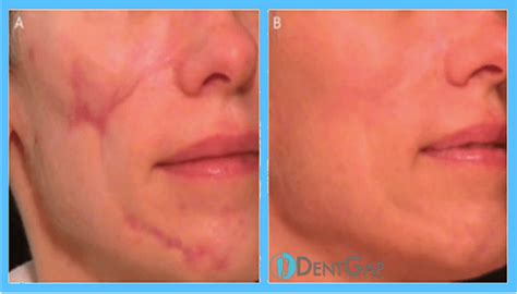 Laser Scar Removal Facts Cost Does It Work