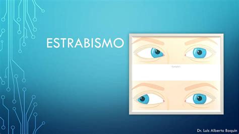 Estrabismo Todo Sobre Medicina Udocz