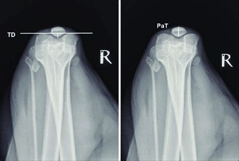 Left Measurement Of Trochlear Depth Td [20] Right Measurement Of Download Scientific