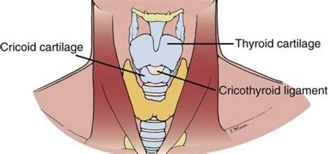 Management Of The Difficult Airway Neonates