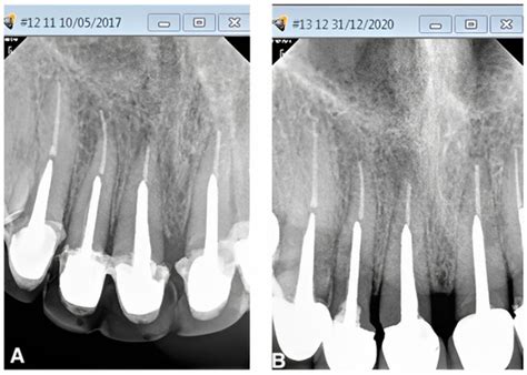 Effect Of The Gap Between Cemented Posts And Remaining Gutta Percha On The Clinical Outcome Of