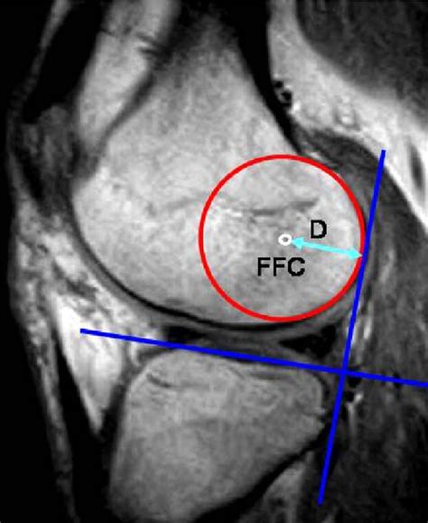 Measurement Of Distance D From A Flexion Facet Centre Ffc To The Measurement Of Distance D From A Flexion Facet Centre Ffc To The