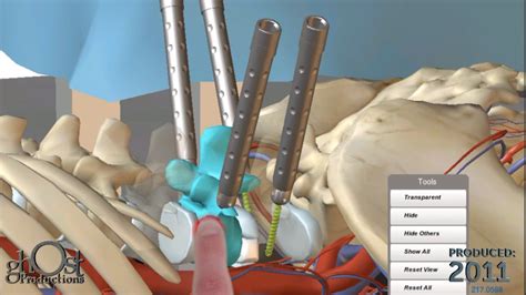 Depuy Spine App Video