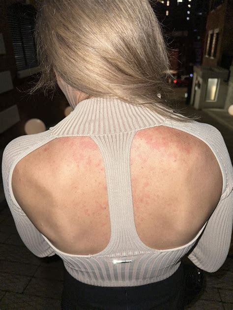 Rash When Drinking Cocktails Since Taking Fluoxetine Rprozac