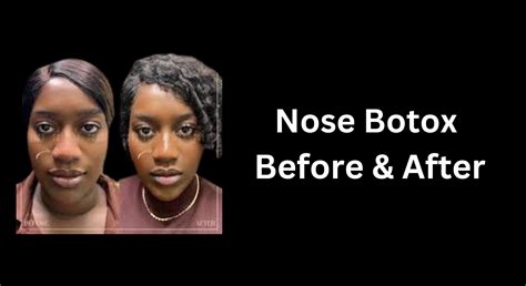 Nose Botox Before And After Transformative Effects