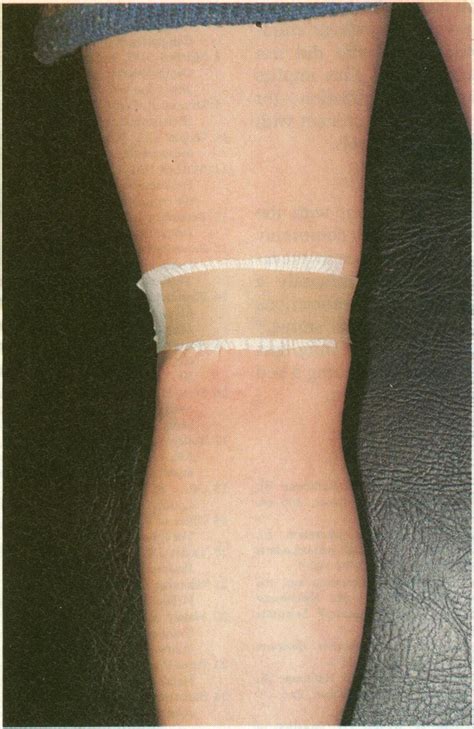 Knee Taping For Patellar Dislocation