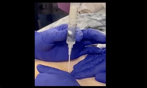 Percutaneous Needle Decompression For Tension Pneumoperitoneum During