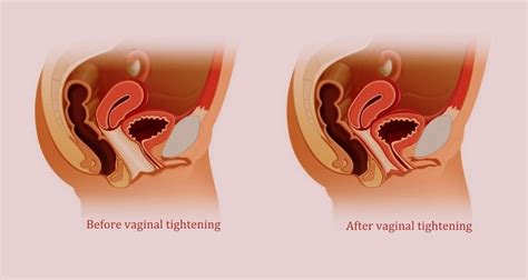 Laser Vaginal Rejuvenation Before And After
