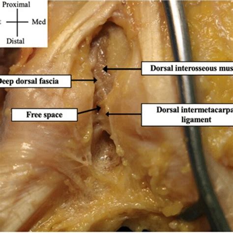 Left Hand Dorsal View Of The Deep Transverse Metacarpal Ligament