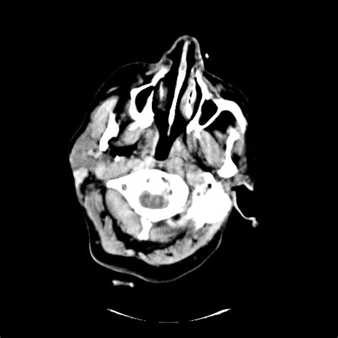 brain hemorrhage detection classification dataset by national textile