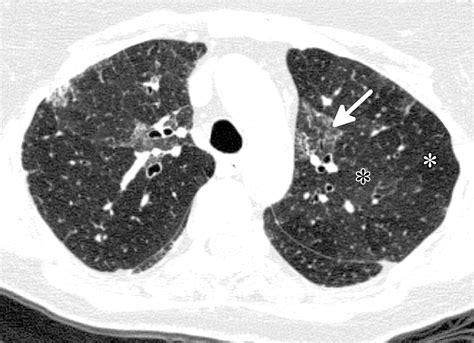 Mosaic Attenuation Etiology Methods Of Differentiation And
