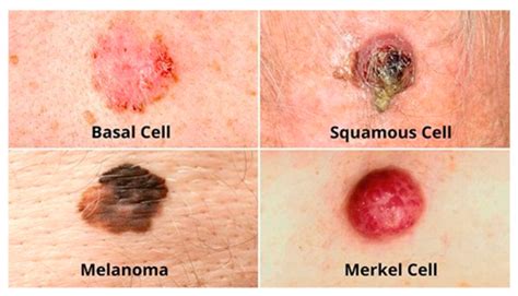 Federated Machine Learning For Skin Lesion Diagnosis An Asynchronous