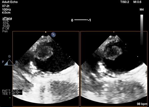 Large Mural Thrombus In The Distal Arch Of The Aorta Without